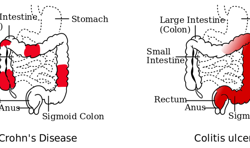 Qu'est ce que la maladie de Crohn ? - Maladies et pathologies ...