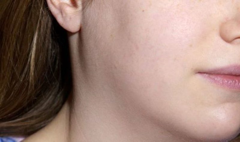 Comment on attrape les oreillons ? - Troubles ORL