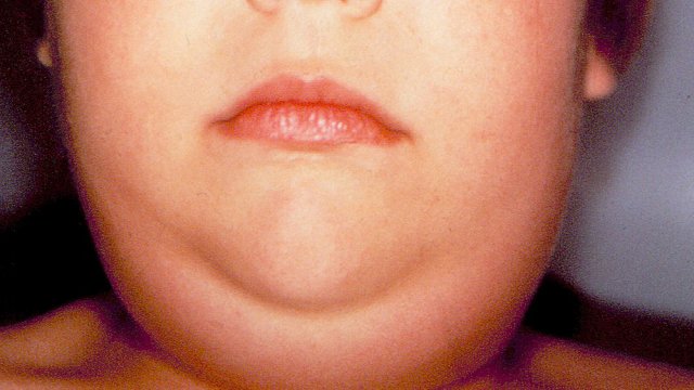 Quels sont les symptômes des oreillons ? - Maladies et pathologies